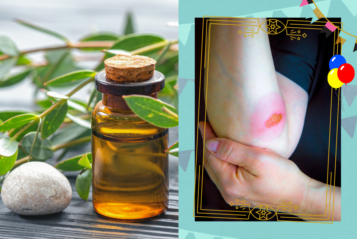 The Best Oil For Treating Skin Burns - Skincell.org