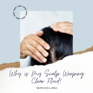 Why Is My Scalp Weeping Clear Fluid? - Skincell.org