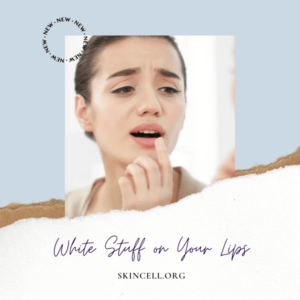 White Stuff On Your Lips - Skincell.org