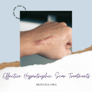Effective Hypertrophic Scar Treatments - Skincell.org
